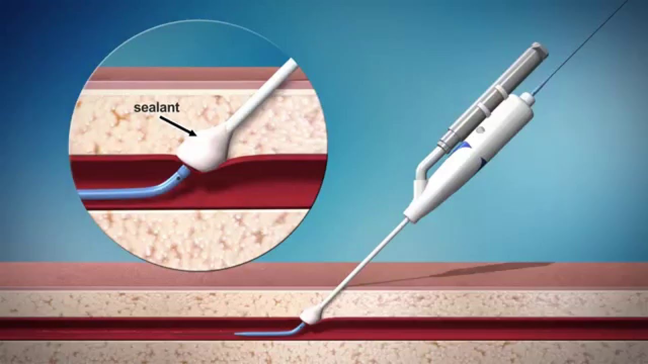 VascuClose XF vascular closure device - YouTube