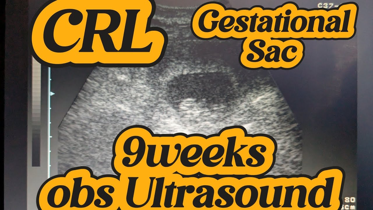 Pregnancy of 9 Week | obs scan | Anomaly Ultrasound | 9 weeks Pregnant ...