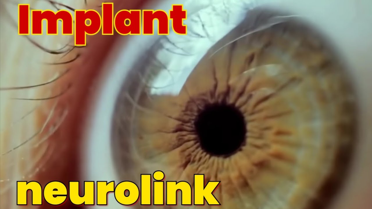 Implant neurolink - YouTube
