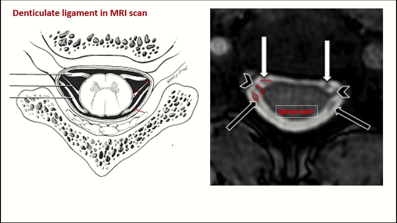 Denticulate Ligaments