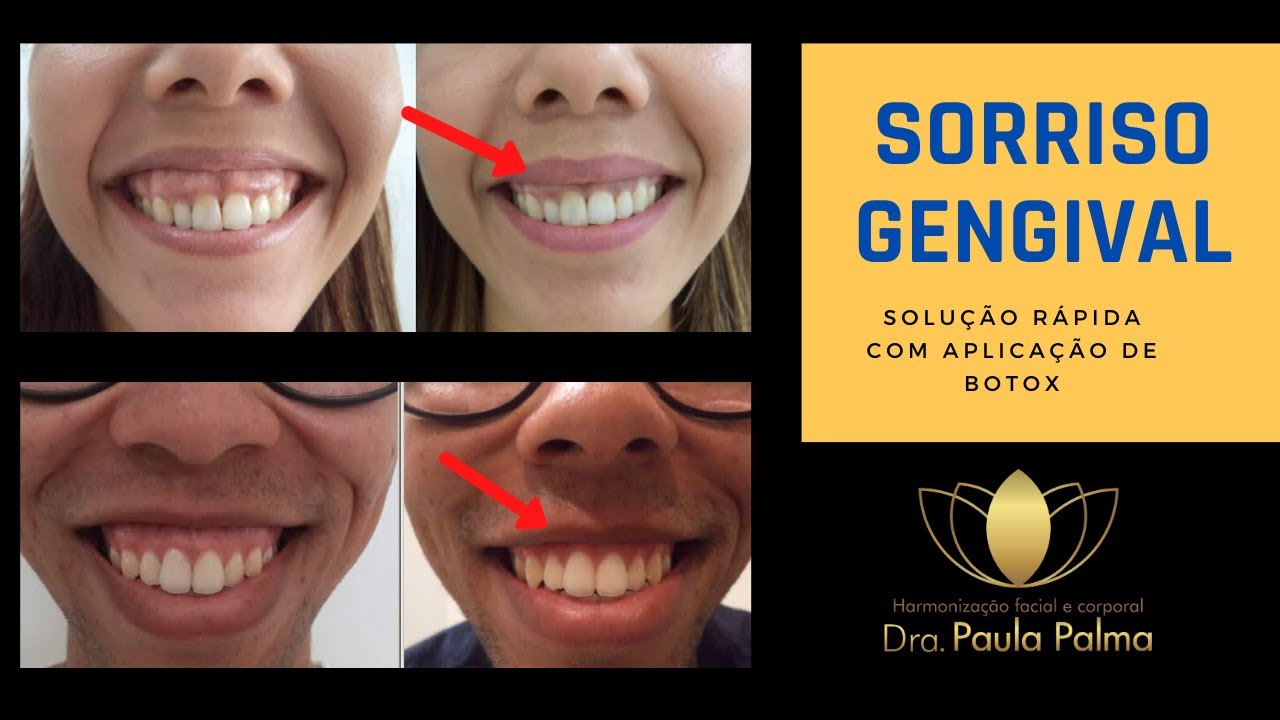 Sorriso gengival, como corrigir com toxina botulínica - Botox - veja ...