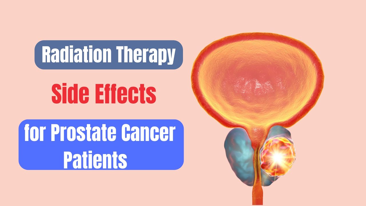 Radiation Therapy Side Effects for Prostate Cancer Patients - YouTube