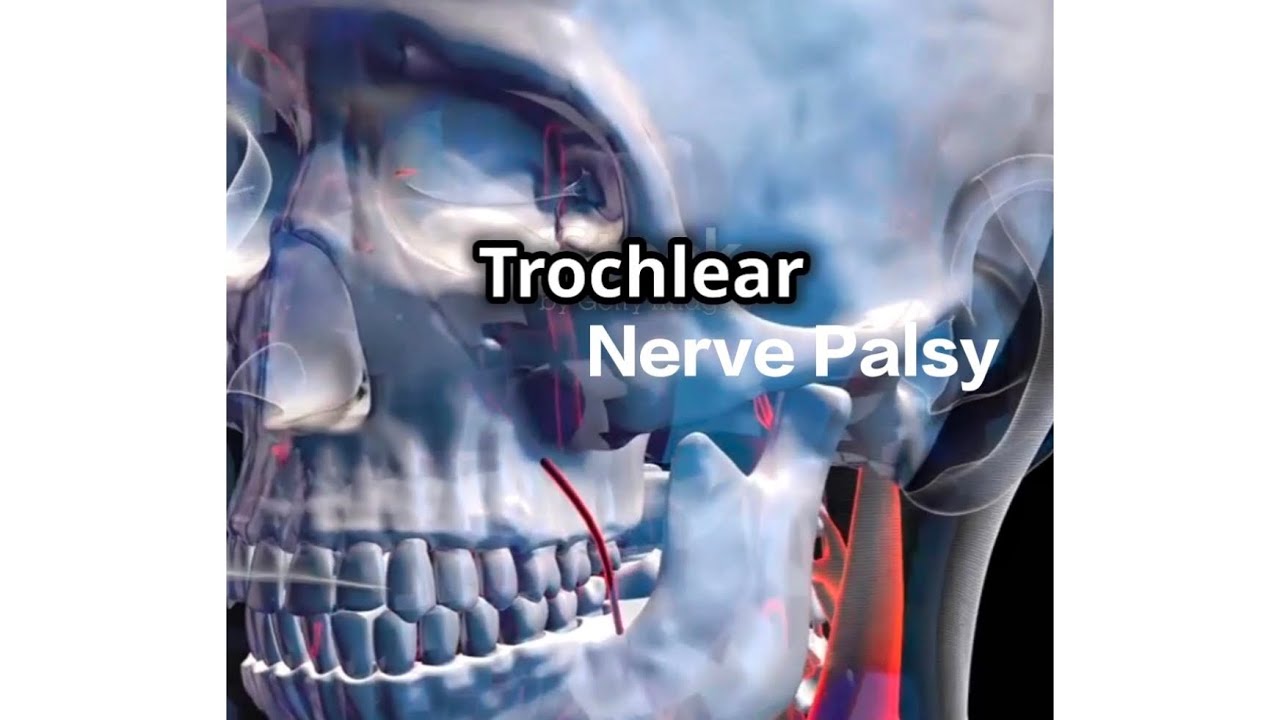 Trochlear Nerve Palsy | English - YouTube