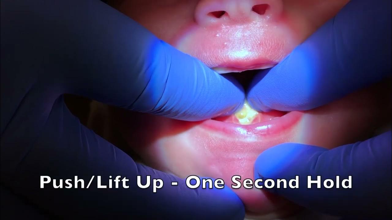 Post - Procedure Stretches for a Tongue Tie Release - YouTube