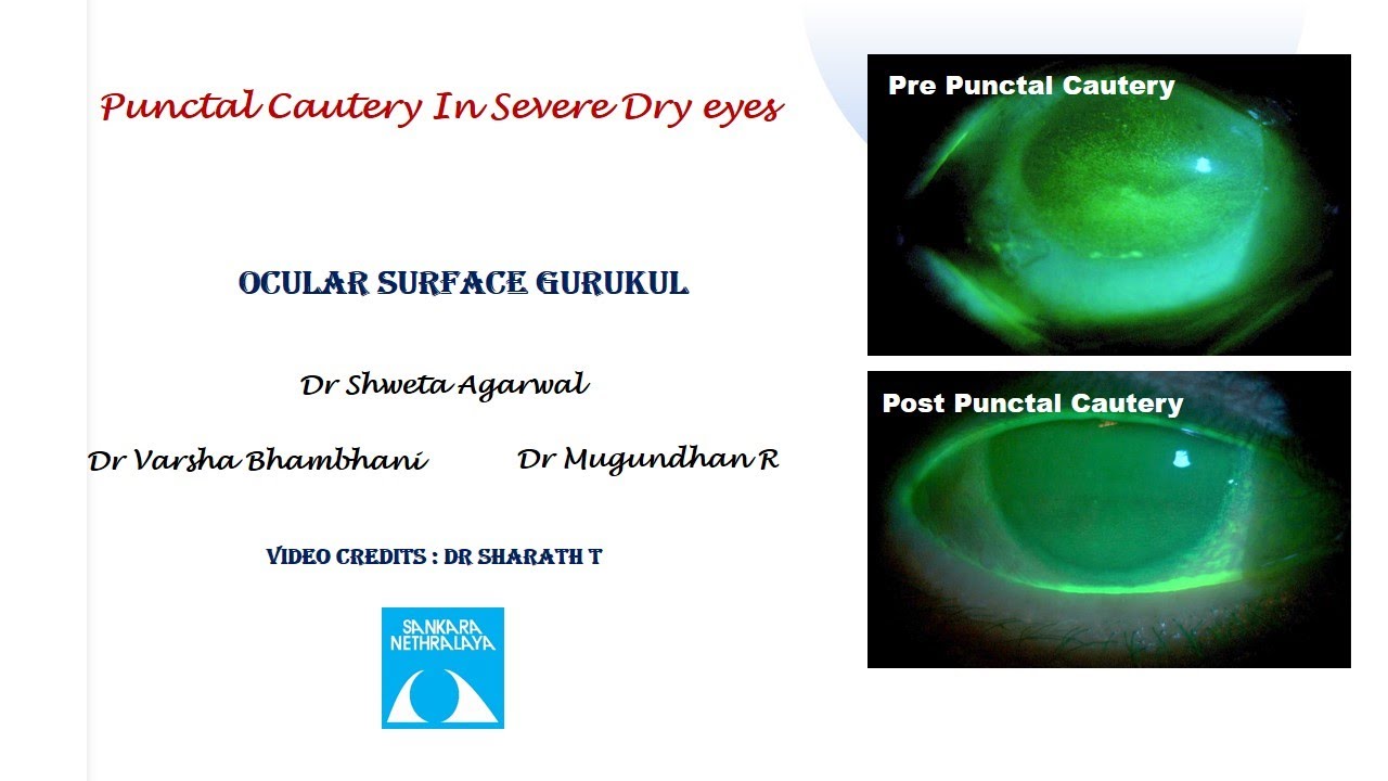 Punctal Cautery For Severe Dry eyes - YouTube