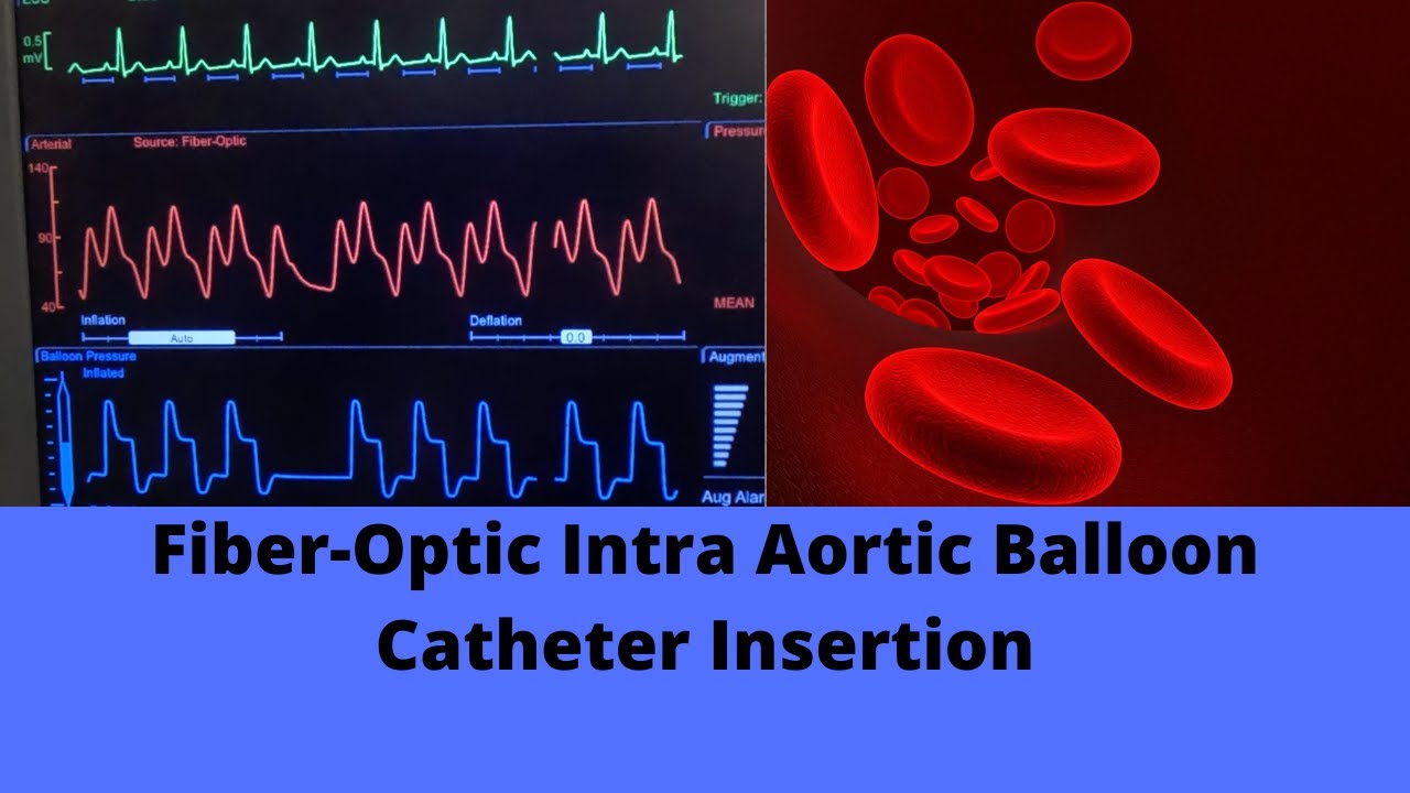 Fiber Optic Intra Aortic Balloon Catheter Insertion - YouTube