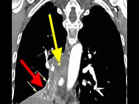 CT CHEST V22 COLLAPSE, ITS TYPES & RIGHT LUNG COLLAPSE #collapse #lungs ...
