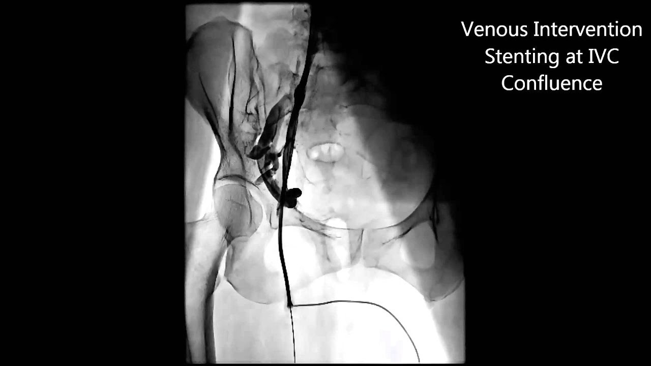 IVC, CIV and FV Stenting by M.Akram Khan, MD from Medical Center of ...
