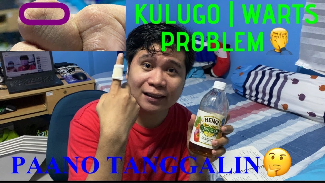 PAANO MAGTANGGAL NG KULUGO OR WARTS | HOME REMEDY FOR WARTS PROBLEM ...