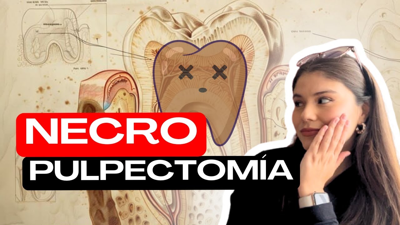 NECROPULPECTOMÍA 🦷💀 | Un paso crucial en el tratamiento de endodoncia ...