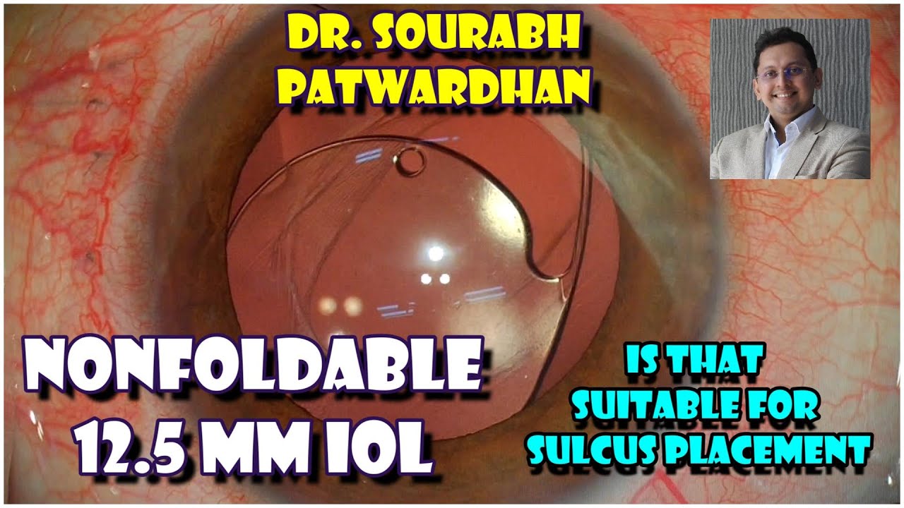 200 Decentered PMMA IOL in sulcus..exchange..causes Dr Sourabh ...