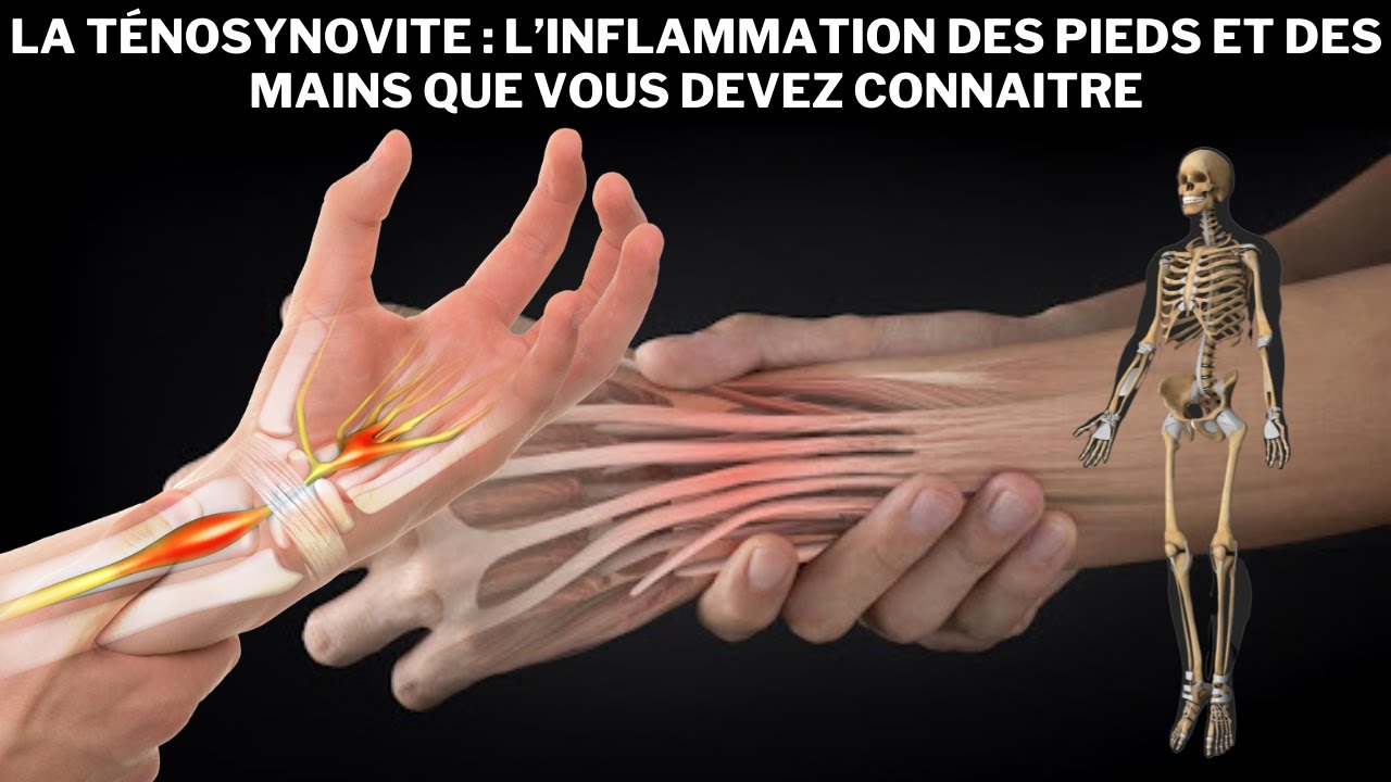 La ténosynovite : l’inflammation des pieds et des mains que vous devez ...