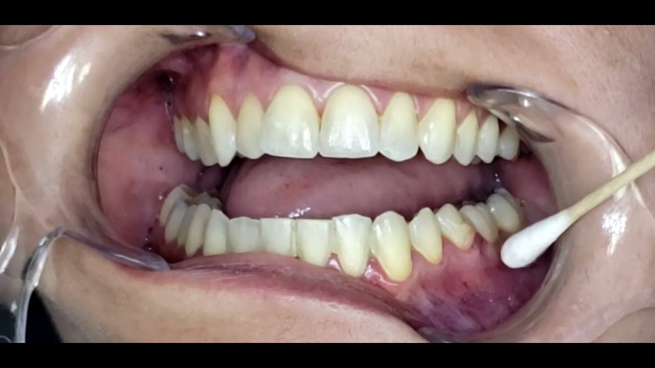 Drenaje de Absceso dental. - YouTube