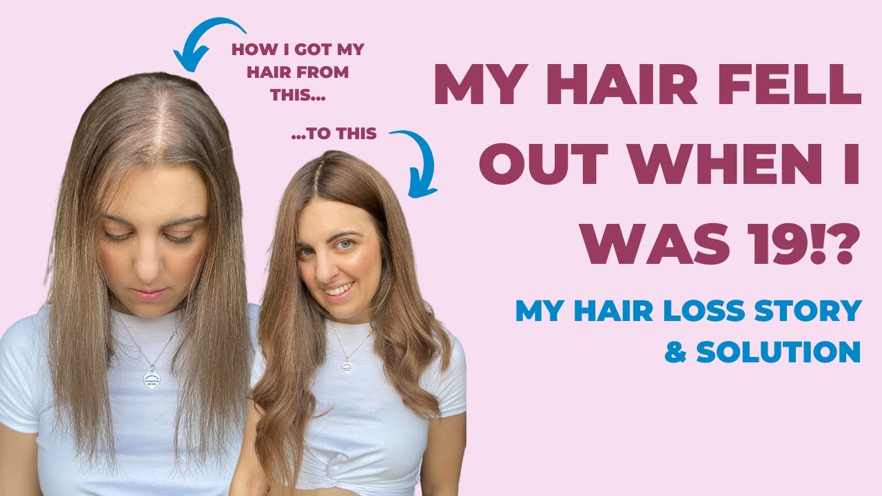 How I lost 50% of My Hair at 19 Years Old (Androgenic Alopecia) - YouTube