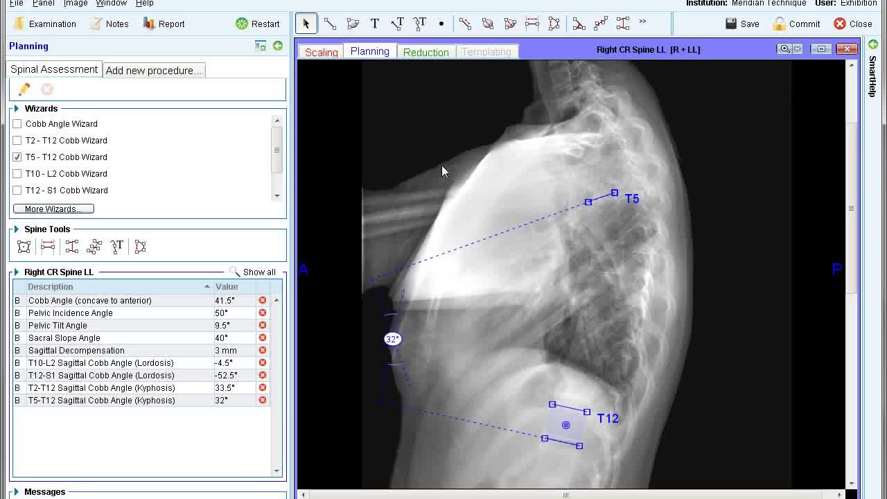 Lateral Spine Assessment | Spine | Materialise OrthoView - YouTube