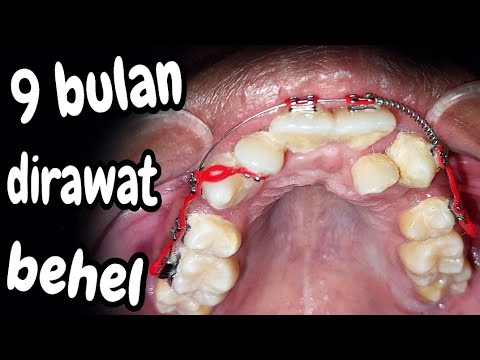 9 bulan perawatan behel gigi berantakan, dokter gigi Jogja menjelaskan ...