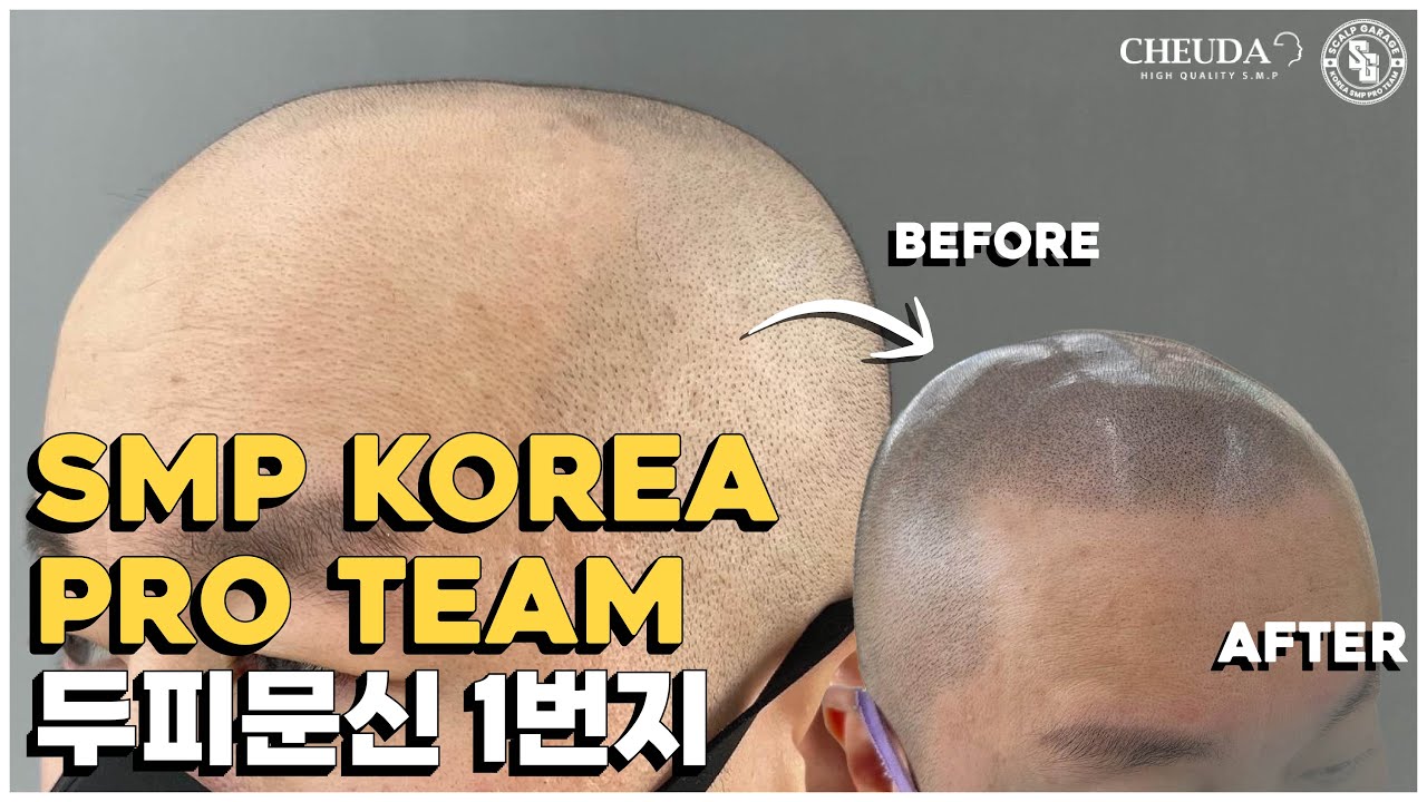 국내유일 타투이스트출신 두피문신 SMP1세대😎 - YouTube