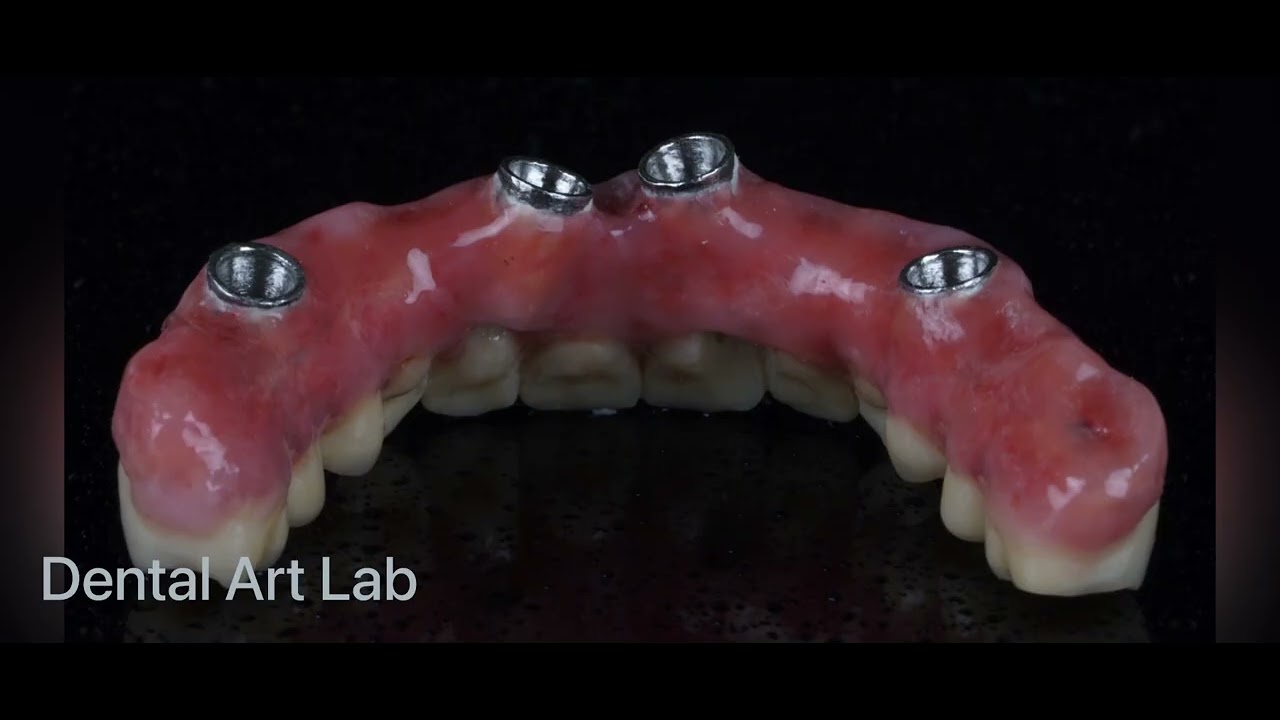 All on four Composite hybrid implant prosthesis. - YouTube