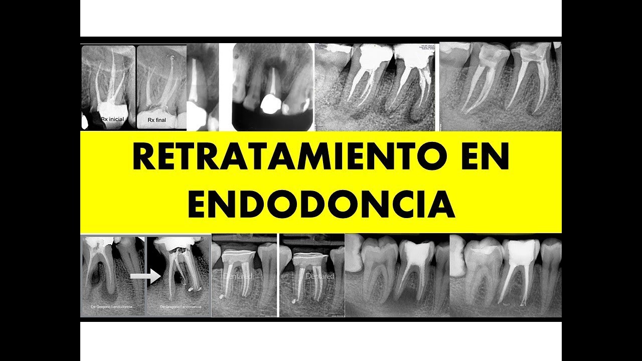 "RETRATAMIENTO EN ENDODONCIA" por el Dr. Arturo Anzardo - YouTube
