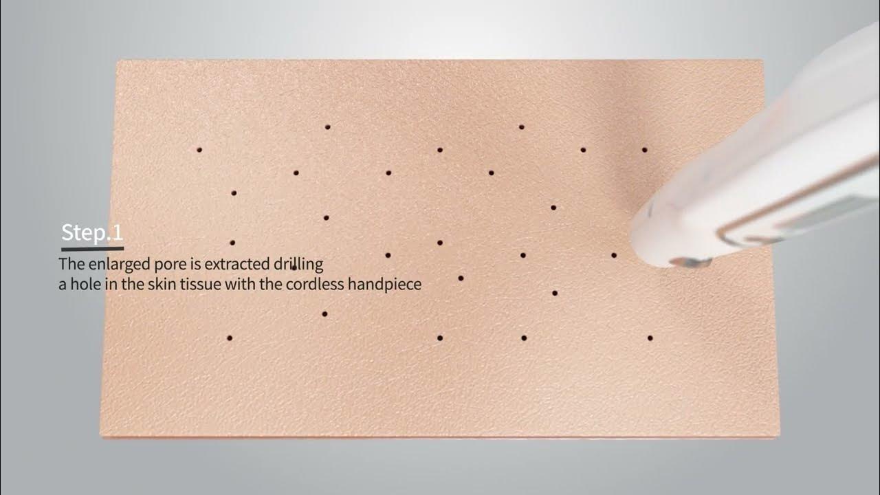 Innovative Fibrous Tissue Remodeling, N-Derm - YouTube