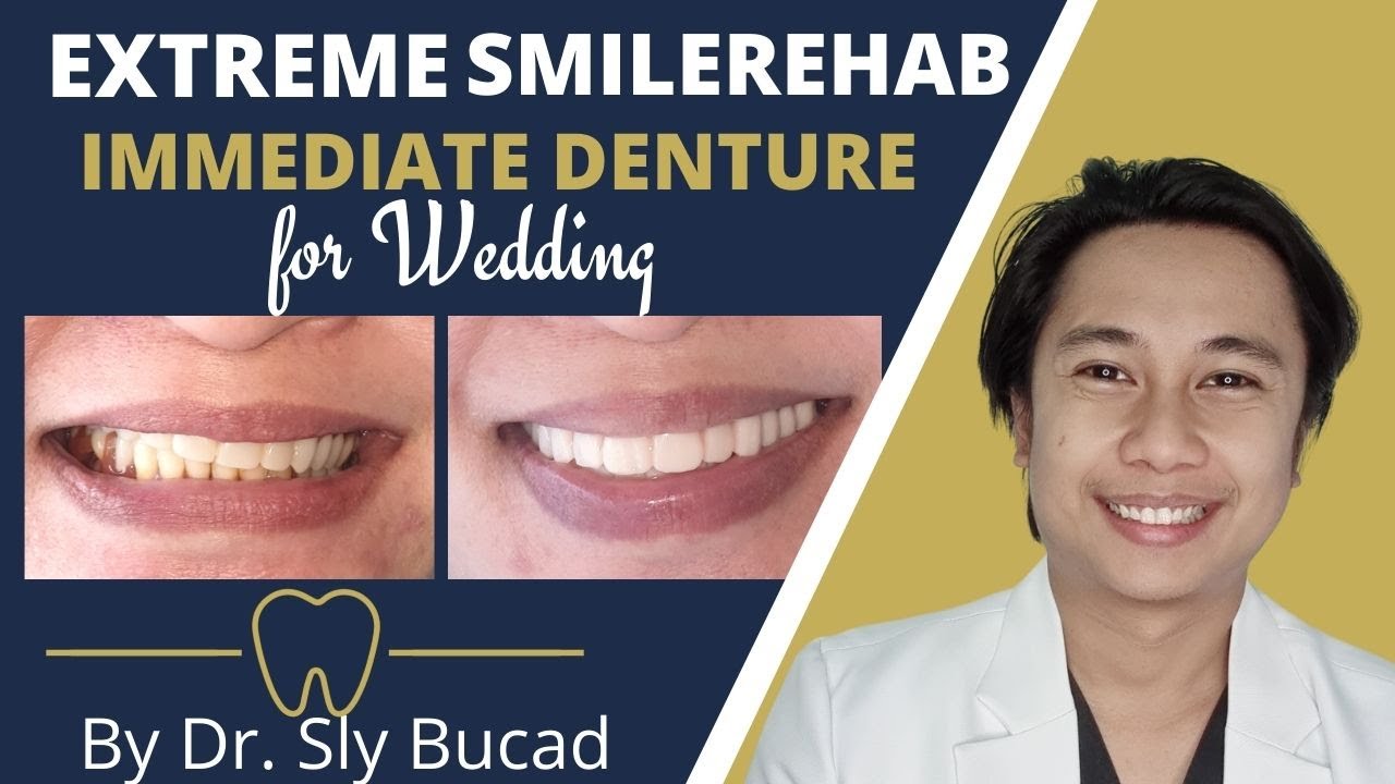 Immediate Denture for Wedding 3D PRINTED COMPLETE DENTURE SMILE REHAB by Dr. Sly - YouTube