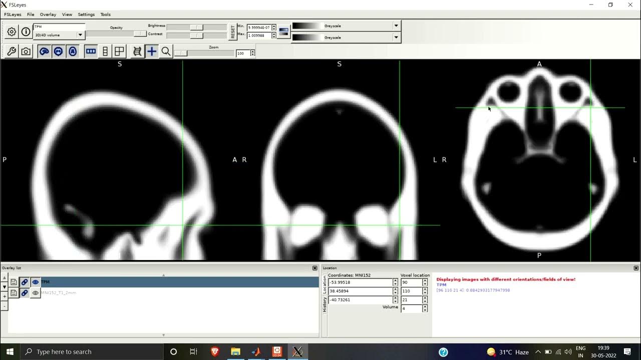 Segmentation of Gray Matter White Matter and CSF | SPM | MATLAB | Resting-state fMRI ...