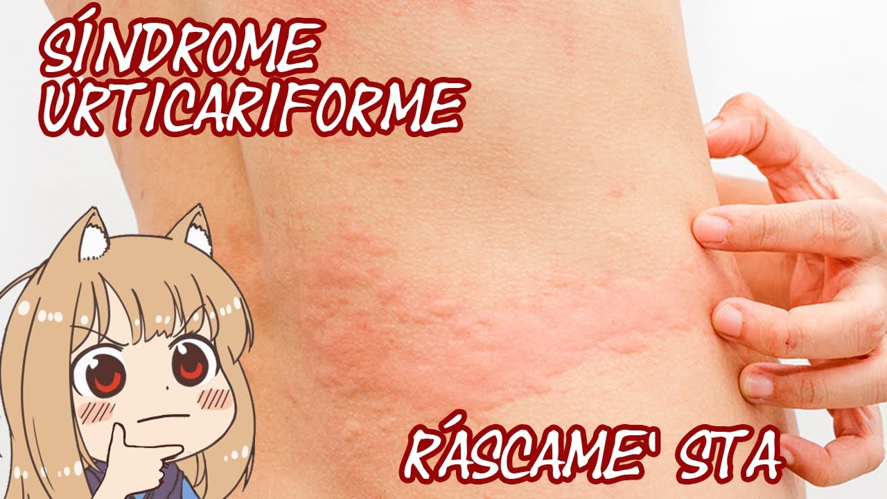 Síndrome Urticariforme | La Raza - YouTube