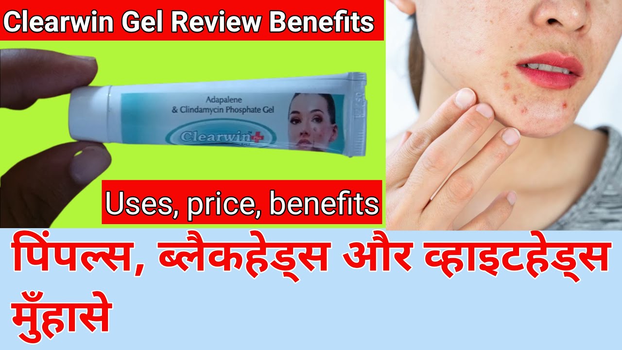 Clearwin gel uses price benefits||पिंपल्स, ब्लैकहेड्स और व्हाइटहेड्स ...