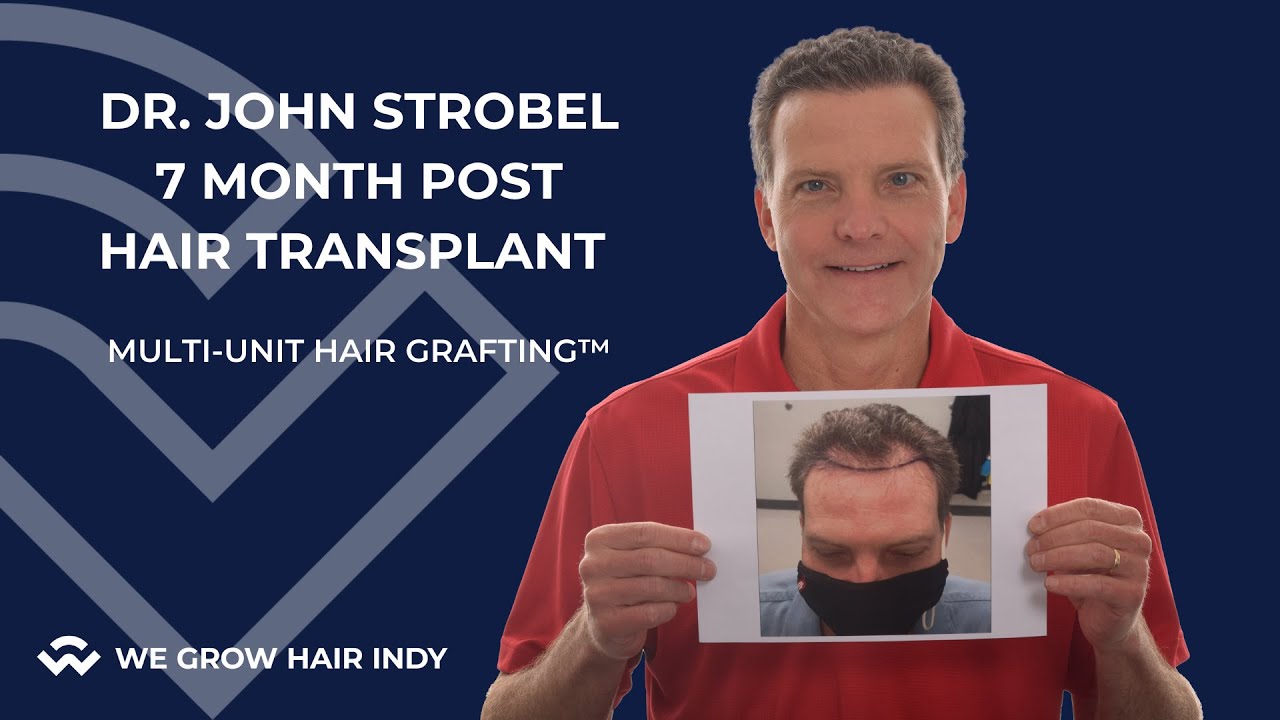 Hair Transplant 7 Months Later - We Grow Hair Indy - Dr. John Strobel ...