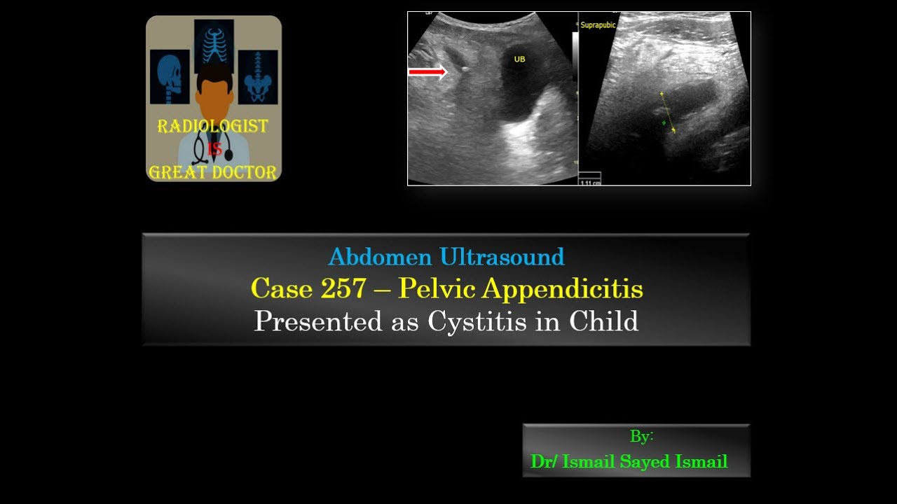 Ultrasound Case 257 - Pelvic Appendicitis (Presented as Cystitis) - YouTube
