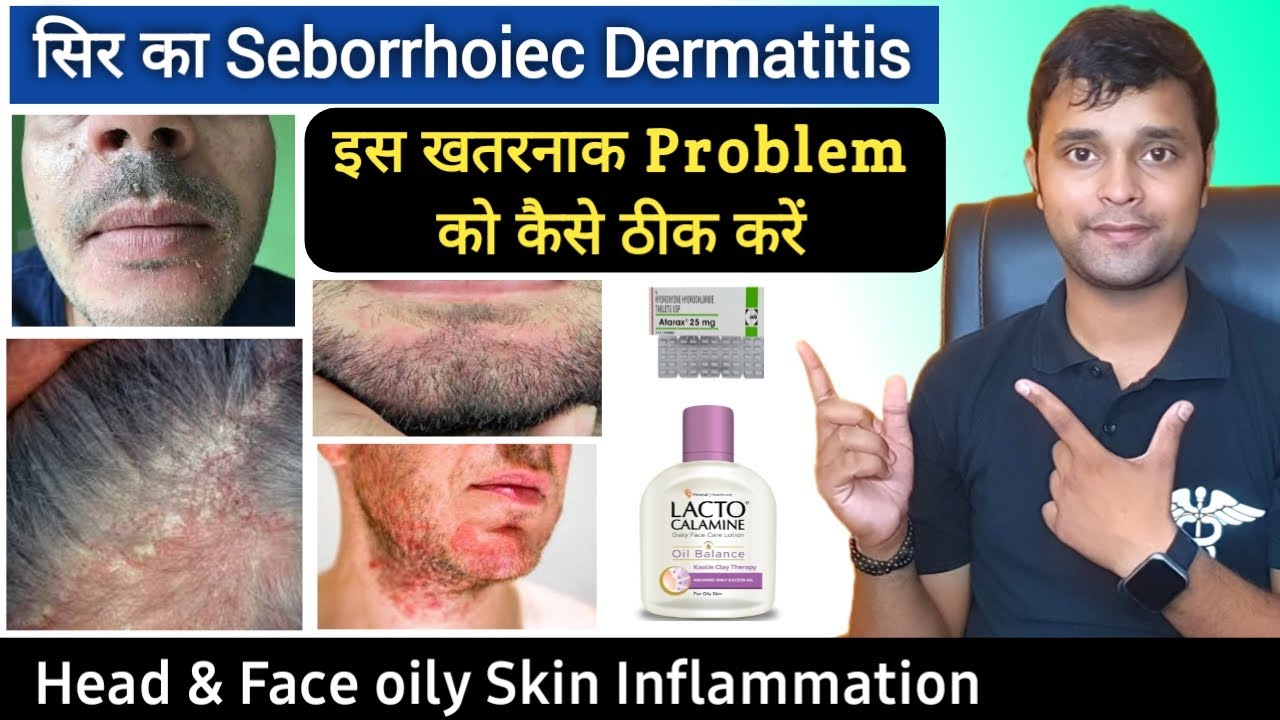 Seborrheic Dermatitis Scalp Treatment Best Medicines For Dermatitis How To Clear Dandruff