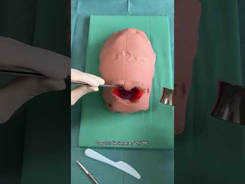 Das passiert bei einem Kaiserschnitt! 🍼👶