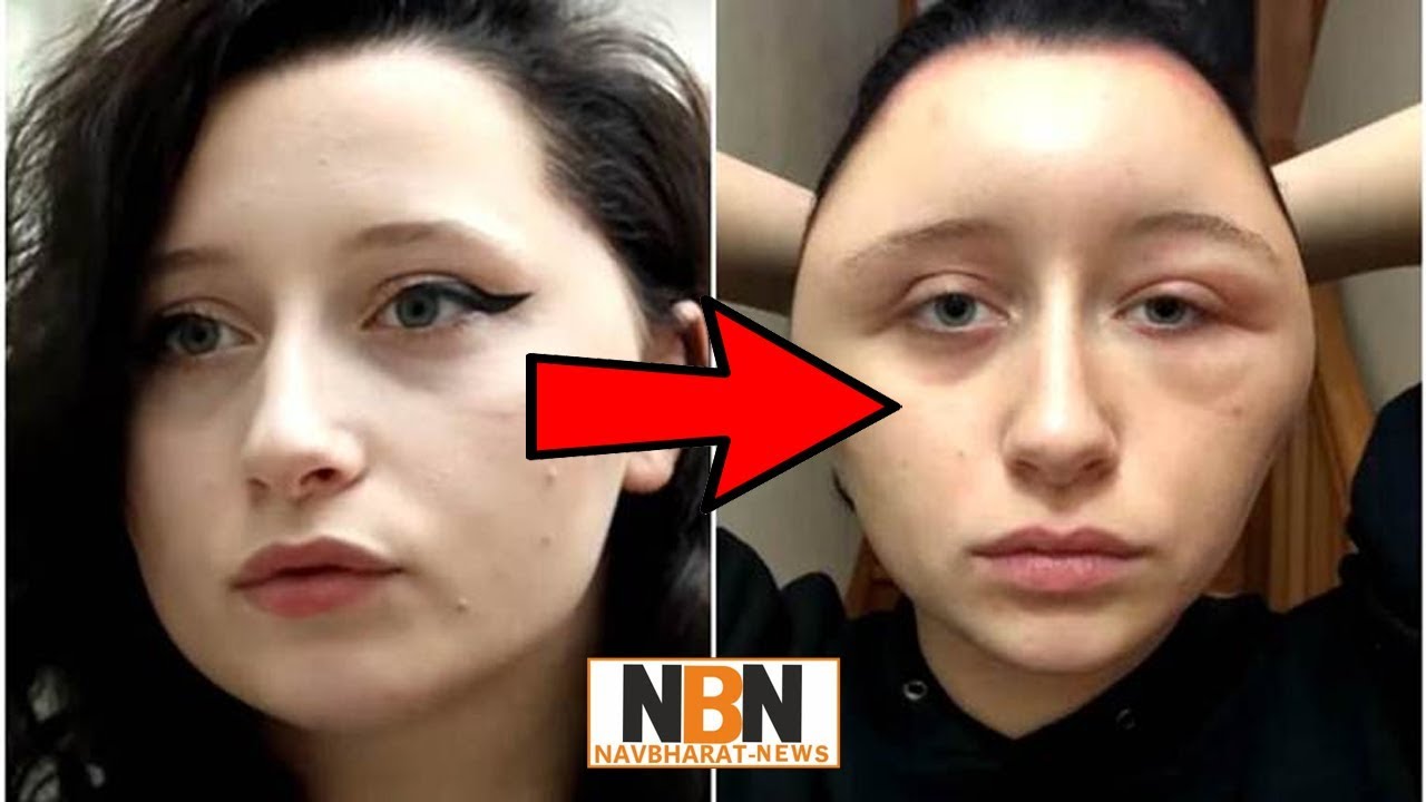 French woman’s head transforms into ‘light-bulb’ | hair dye | Navbharat ...