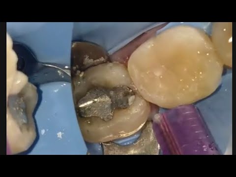 amalgam replacement with composite .amalgam filling removal - YouTube