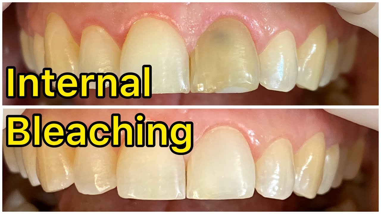 30 years old female / tooth discoloration / internal bleaching / Dr ...