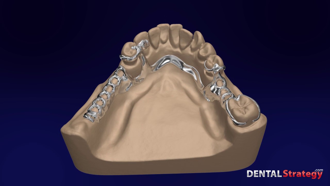 PPR inferior Classe II modificação 1 - YouTube