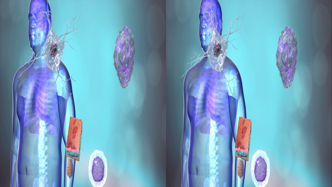 Psoriasis inflammation in 3D - NL - YouTube