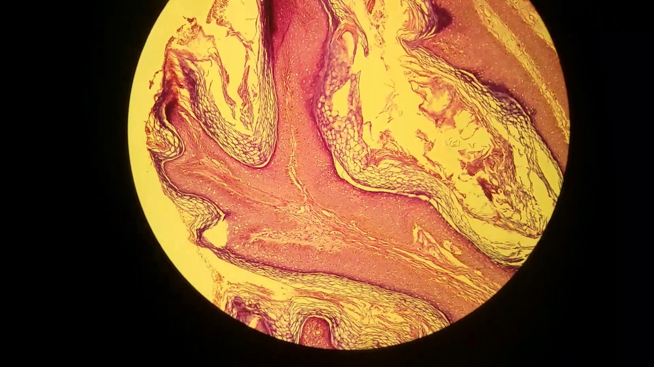 Skin squamous cell papilloma wart - YouTube