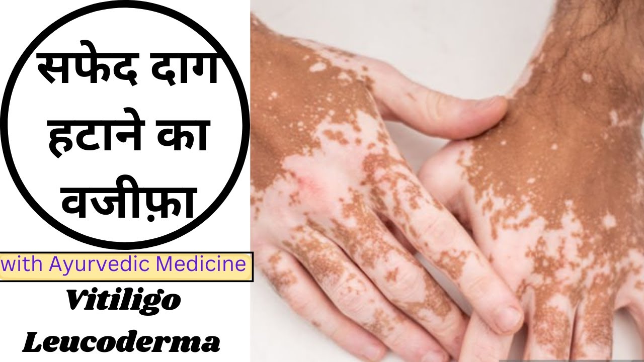 Safed daag hatane ka wajifa . Vitiligo treatment. Leucoderma treatment dua - YouTube