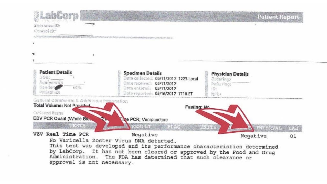 Varicella Zoster Virus (Shingles) NEGATIVE PCR Test Following Scalar ...