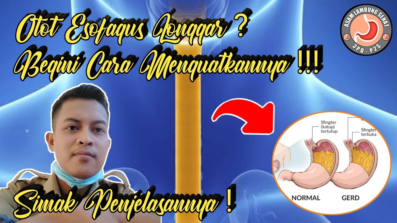 Cara Menguatkan Otot Esofagus Yang Longgar Karena Gerd - YouTube