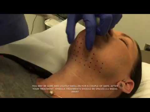 Kybella Injections! - YouTube