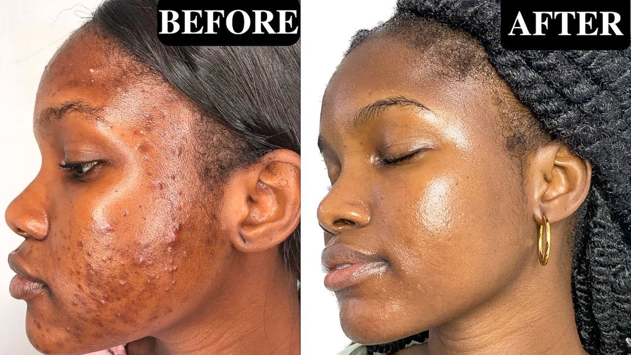How I cleared my 2 years ACNE & HYPERPIGMENTATION | How I got rid of ...