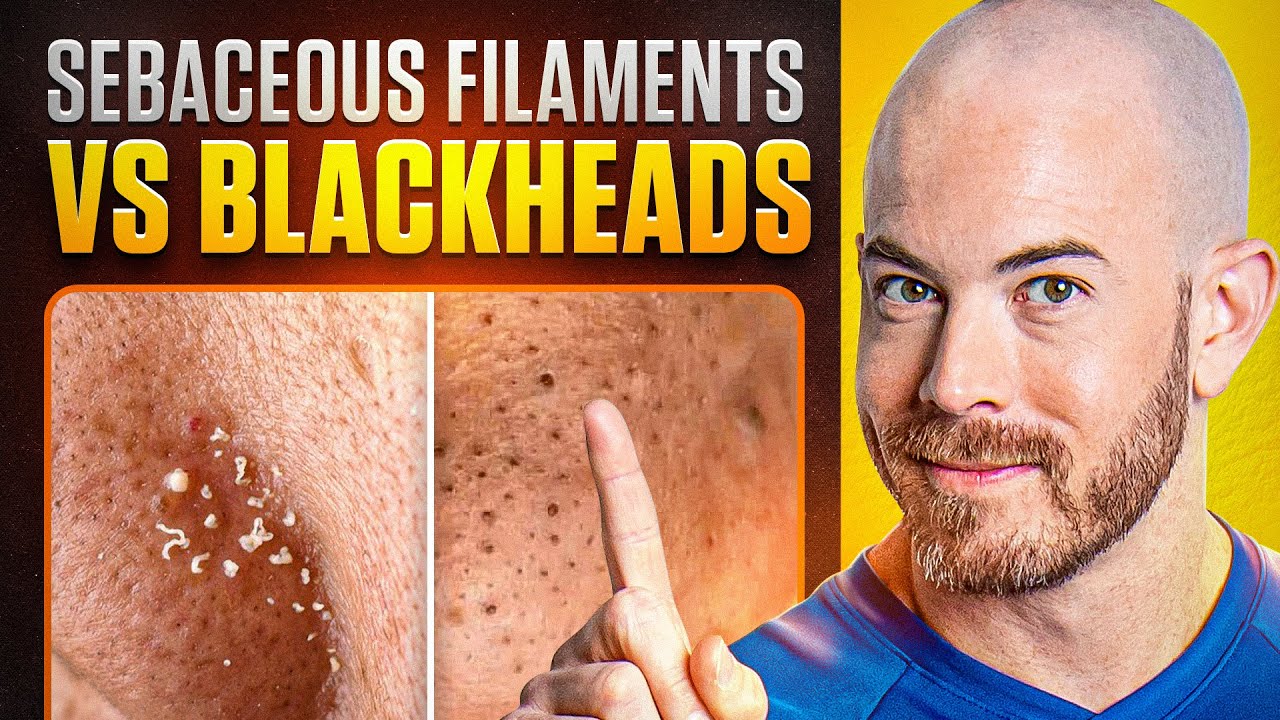 Do You Have Sebaceous Filaments or Blackheads? - YouTube
