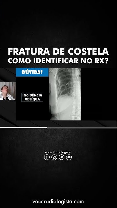 Como identificar uma fratura de costela no RX? ⚡ - YouTube