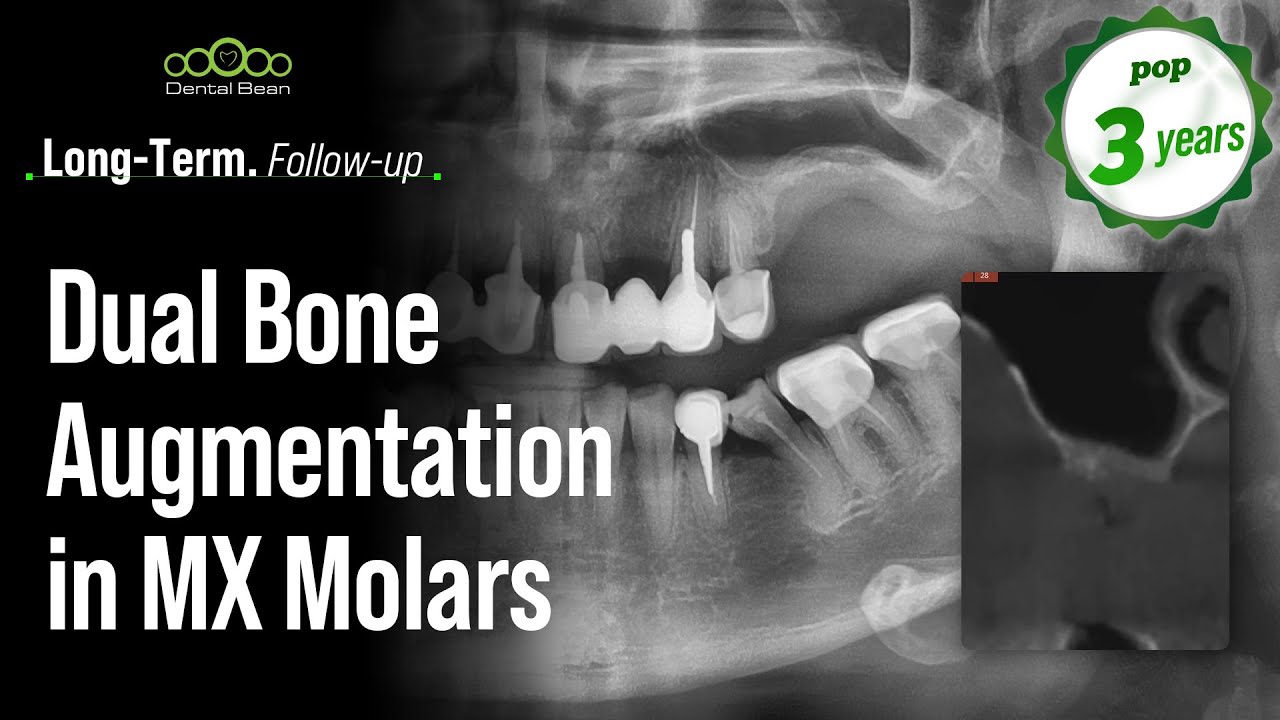 Simultaneous sinus lift and lateral ridge augmentation [Dr. Cho ...