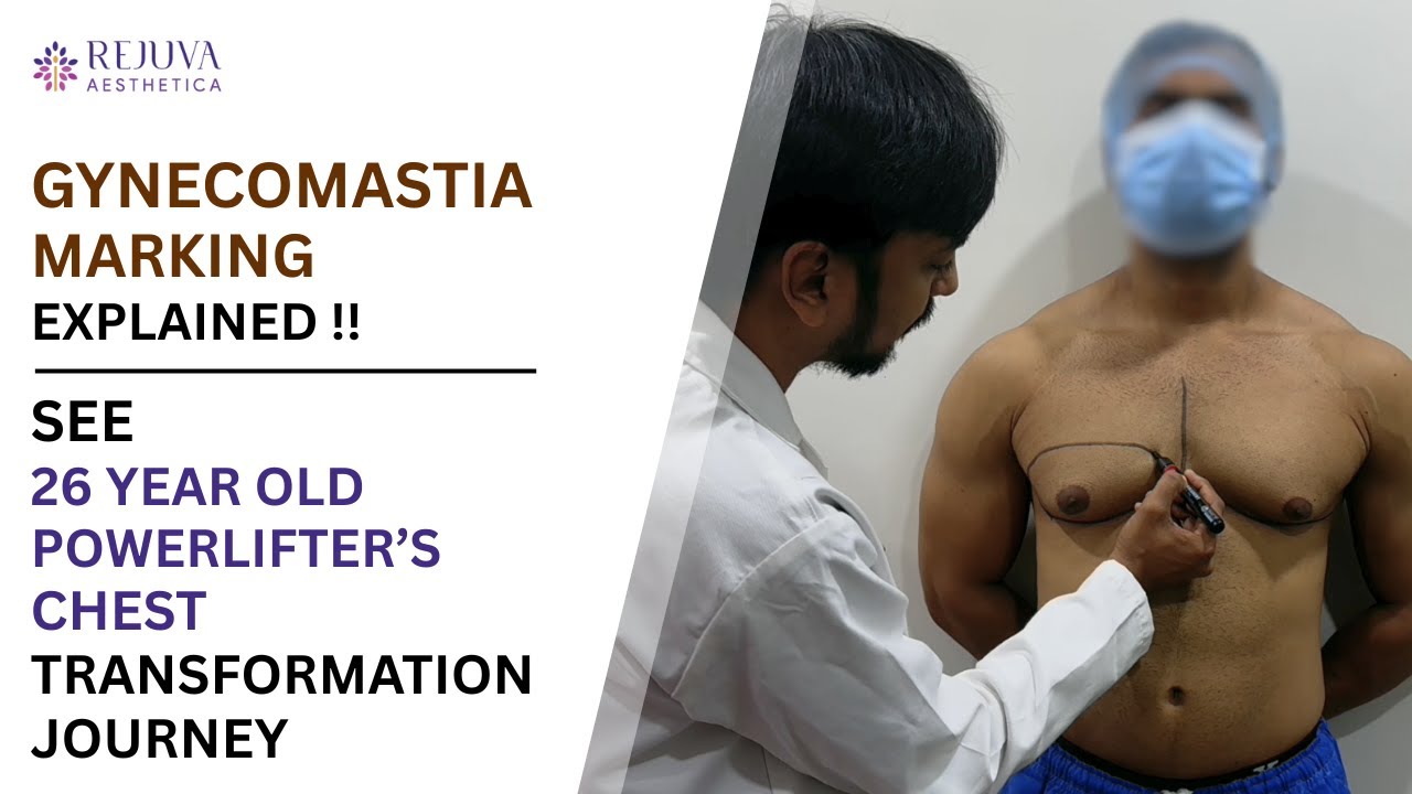 How precise Marking Shapes results in Gynecomastia Surgery? Powerlifter ...