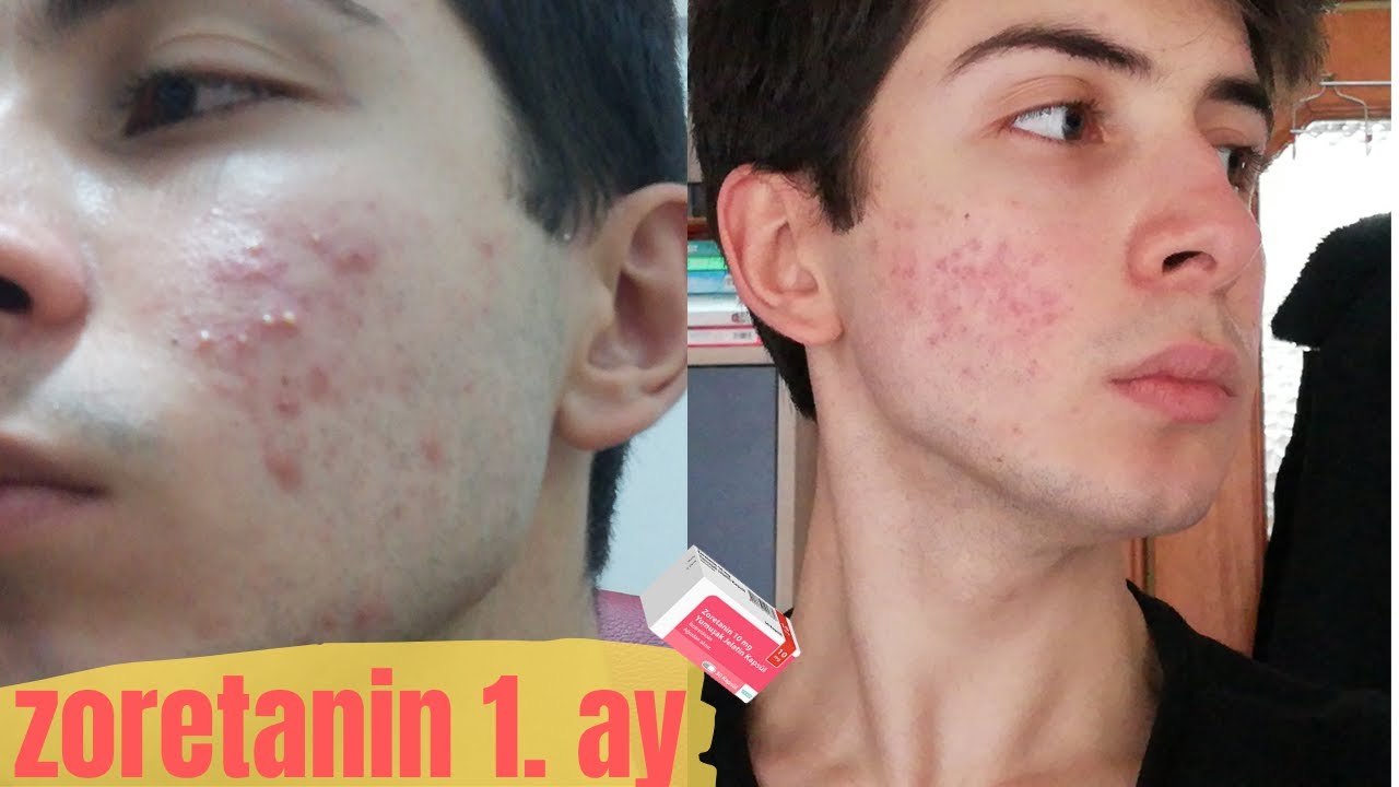 Zoretanin sivilce Tedavisi 1.ay | Roaccutane - Aknetrent - Acnegen ...