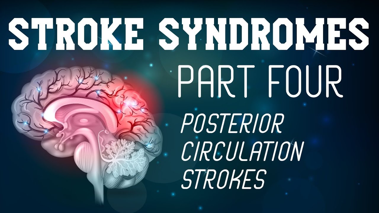 Stroke Syndromes (Part 4 of 4) - Posterior Circulation Strokes - YouTube