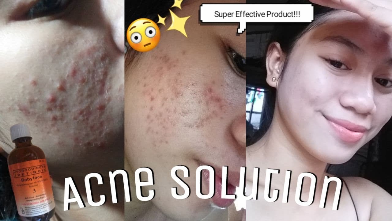 MY ACNE JOURNEY USING RDL BABYFACE (Solution 2 and 3) - YouTube